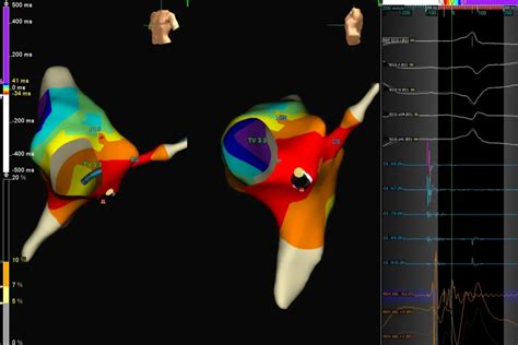 3d Ablation And Mapping Prof Dr Taylan Akgün