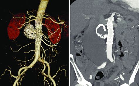 Computed Tomography Ct Angiographic Image 6 Weeks Following