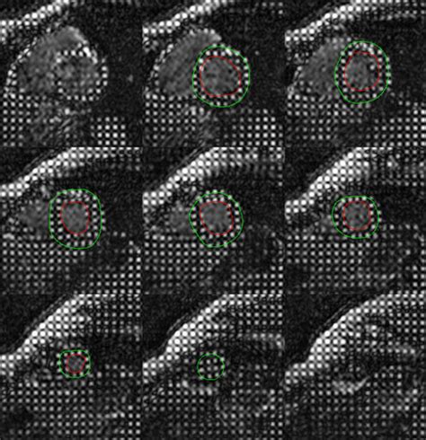 Mr Tissue Tagging In Short Axis Orientation For Strain Analysis Of The
