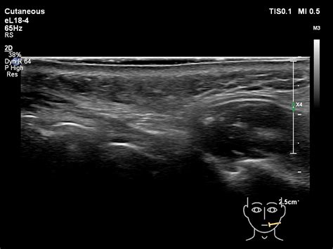 PLLA 27a Cutaneous