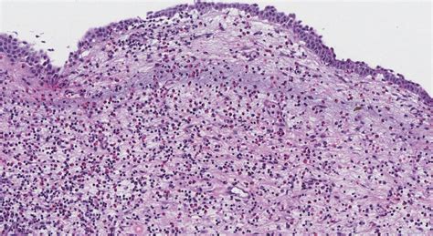 Chronic Rhinosinusitis Ottawa Atlas Of Pathology