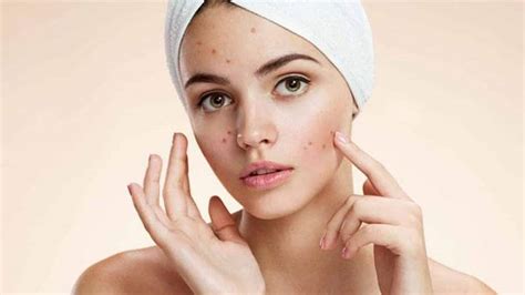 Acne Woes Follow These Simple Tips To Keep Pimples At Bay Health