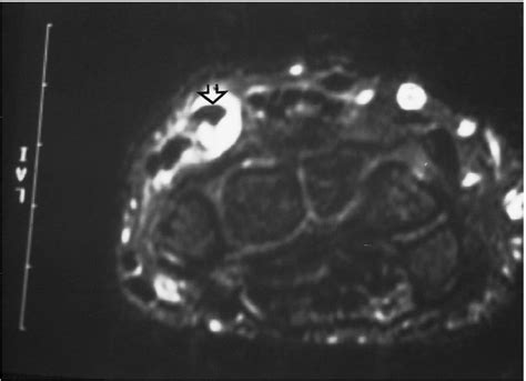 Extensor Pollicis Longus Tendonitis Wikism Sports Medicine Wiki
