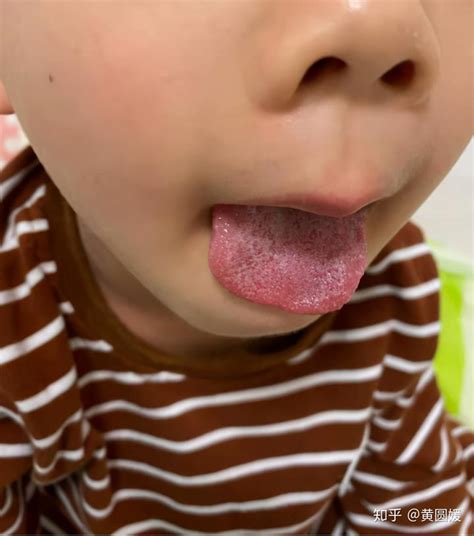 舌苔发红上面有小红点是怎么回事 知乎
