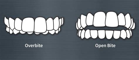 Overbite What Is It And Why Correcting An Overbite Is Important