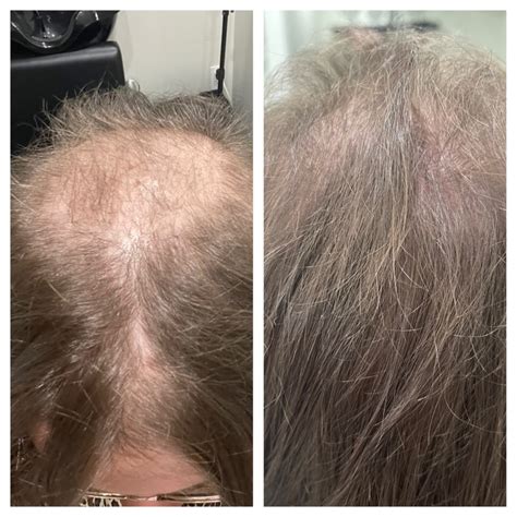 Weight Loss And Hair Loss Uncovering The Connection Noellesalon