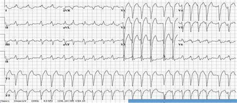 Ecg Of The Month A 76 Year Old Woman Presents With Frequent Pvc
