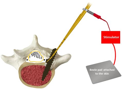 stimulation of a traversing nerve root in the spinal canal by the probe