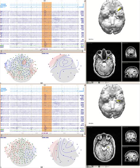 Multimodal Neuroimaging And Treatment In Medically Refractory Epilepsy