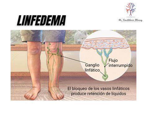 El Principal Síntoma Del Linfedema Es La Hinchazón De Una Extremidad