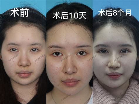 鼻综合术后可以将原本面部优点展现出来吗？ 知乎