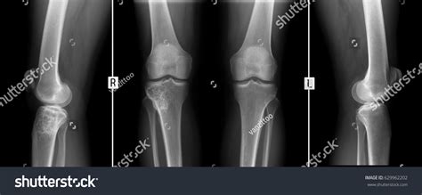 12 Imágenes De Tibial Tumor Imágenes Fotos Y Vectores De Stock Shutterstock