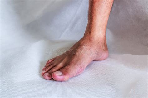 Mykose Des Bereichs Zwischen Den Zehen Stockbild Bild Von