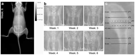 Osteomyelitis Bone Scan