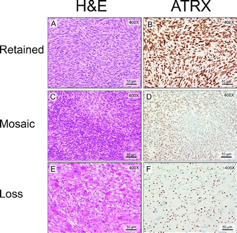 Mpnsts Show Three Distinct Patterns Of Atrx Staining Routine Download Scientific Diagram