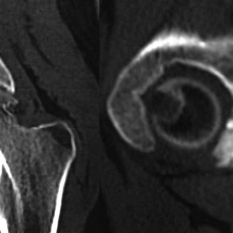 Ct Scan Bone Sclerosis With A Subchondral Lytic Lesion Centered By The