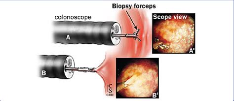 Biopsy Of Colonic Mucosa Download Scientific Diagram
