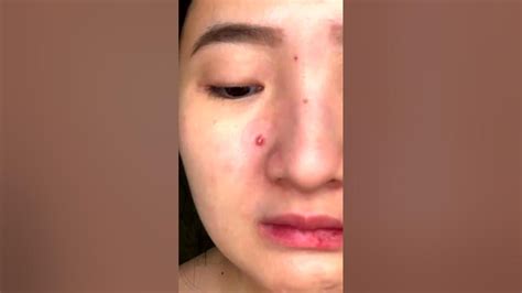 Pimples Removal Tiktok Compilation Extracting Blackheads And