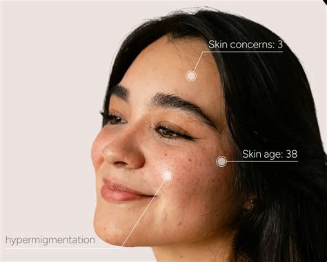 Dark Forehead Causes Hyperpigmentation And Treatment