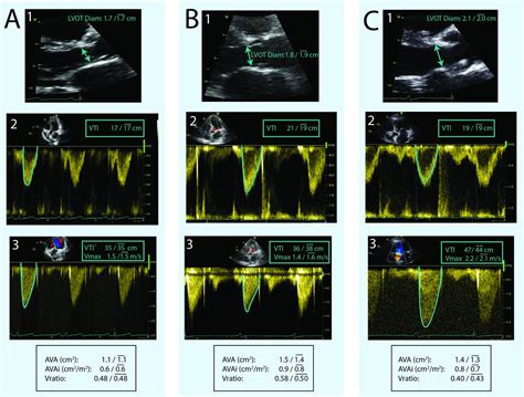Aortic Stenosis Echo Doppler