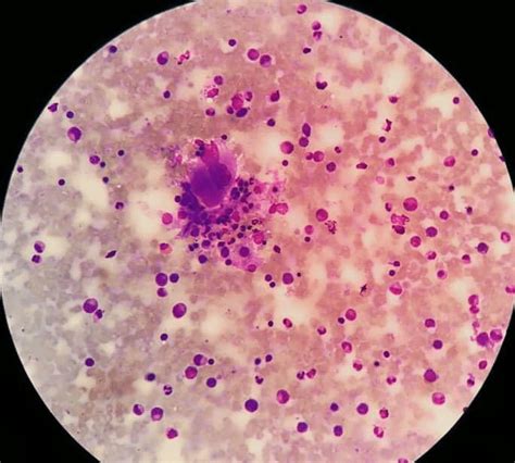 Bone Marrow Aspirates Examination Showed A Normocellular Marrow With