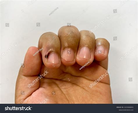 Felon Hand