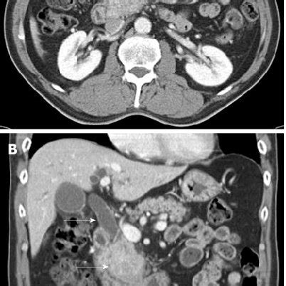 Initial Abdominal Computed Tomography Scan Revealed An Illdefined
