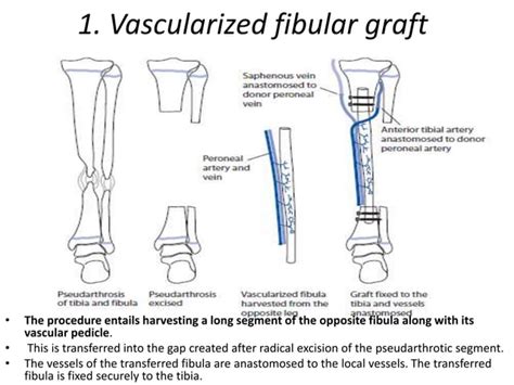 Congenital Pseudo Arthrosis Of Tibia PPTX