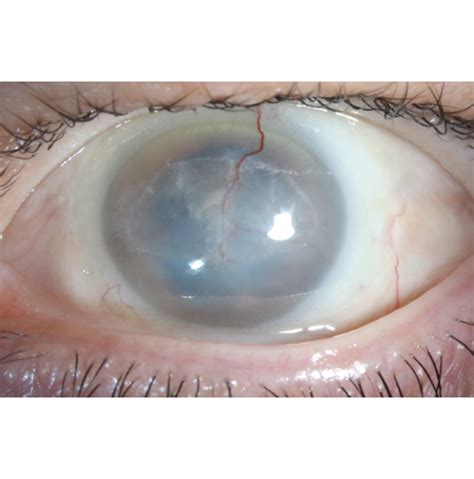 Mitomycin Intravascular Chemoembolization Mice Eyewiki