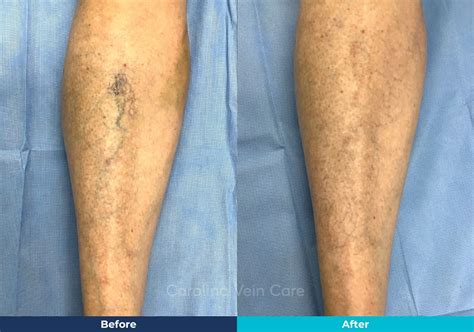 Spider Veins Carolina Vein Care