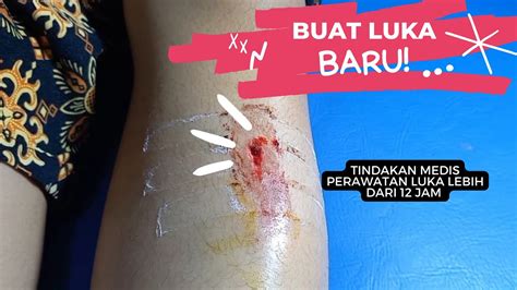 Tindakan Medis Perawatan Luka Lebih Dari Jam Yang Masih Belum Kering Seluruhnya Youtube