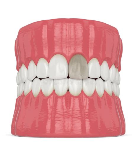 3d Render Of Jaw And Tooth With Dead Pulp Stock Illustration