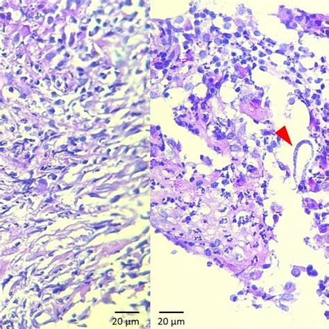 Histopathology Of Skin Lesions Associated With D Immitis Infection In