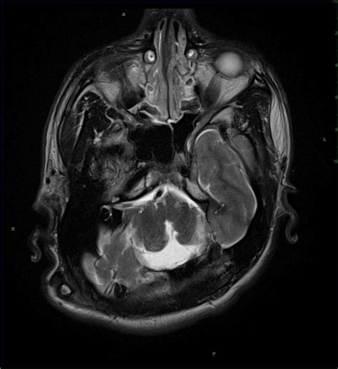 Callosal Dysgenesis Cortical Gray Matter Heterotopia And Small