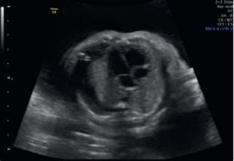 Pleural Effusion Fetal Ultrasound Thoracoamniotic Shunt Creation Fetal