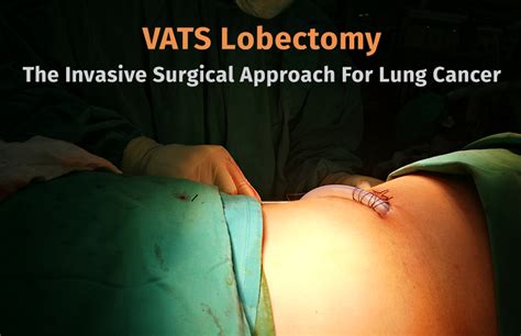 Vats Lobectomy — The Invasive Surgical Approach For Lung Cancer By