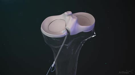 Arthrex Sutureloc™ Implant For Meniscal Root Repair