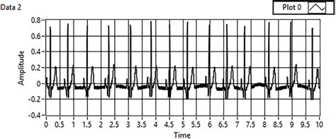 Unfiltered Ecg Signal 101371journalpone0279305
