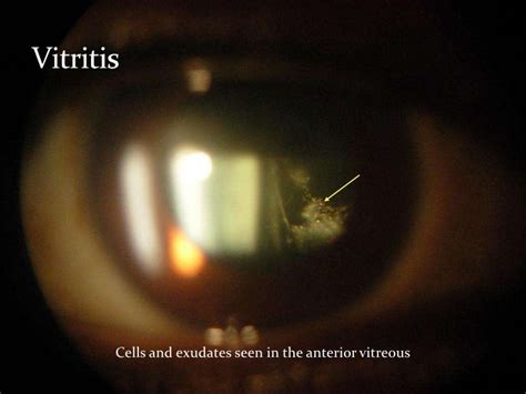 Overview Of Uveitis Part2 Clinical Features