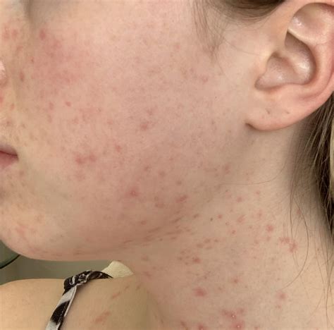 Help I Started Clindamycin Lotion About 2 Weeks Ago Is This Normal