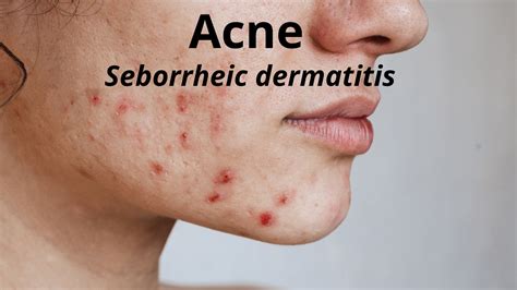 Acne Seborrheic Dermatitis Imithi Yesintu