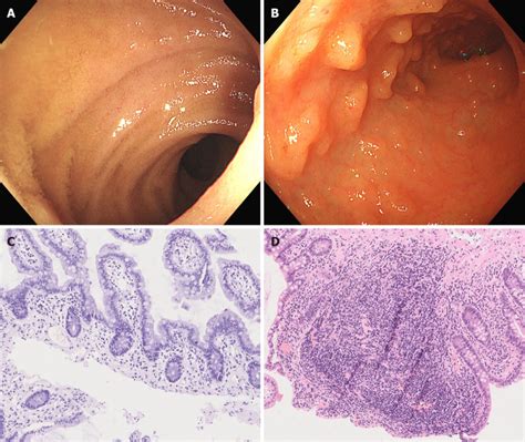 Mucosal Bacterial Dysbiosis In Patients With Nodular Lymphoid