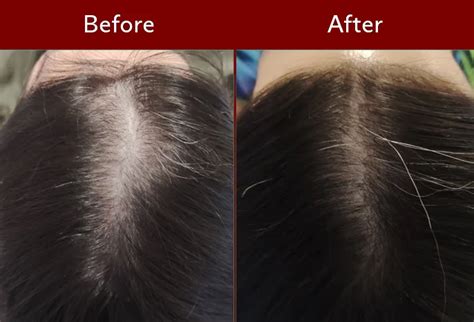 Folix Laser Non Invasive Hair Loss Treatment Scottsdale Institute For Cosmetic Dermatology