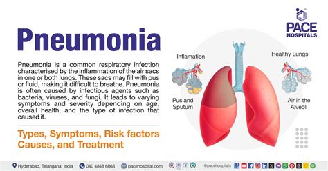 Atypical Pneumonia Causes Walking Pneumonia What Is It Causes