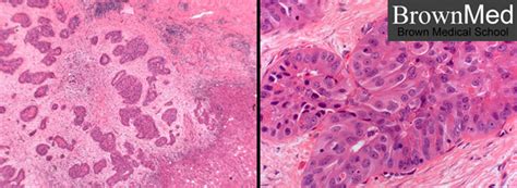 Cholangiocarcinoma Histology