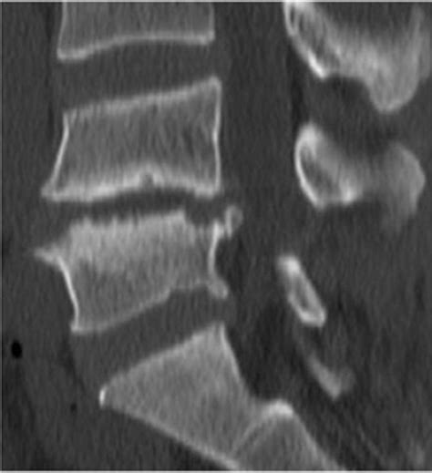 Complications Of Basivertebral Nerve Ablation Anesthesia Key