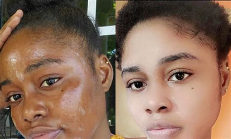 Skin Bleaching Gel Cream At Jane Shepherd Blog