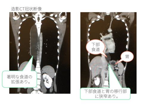 食道アカラシアとは？症状や原因、検査方法のまとめ！