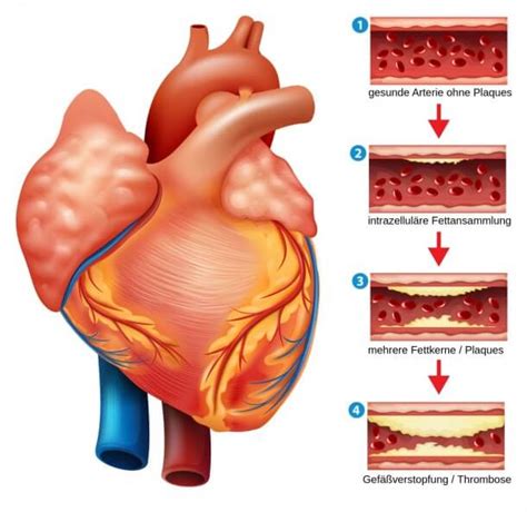 Arteriosklerose Die Typischen Symptome Erkennen