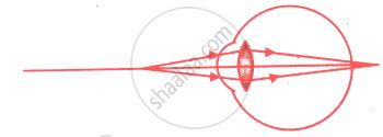 Given Below Is Diagram Showing A Defect Of Vision Name The Defect Of Vision And Draw An